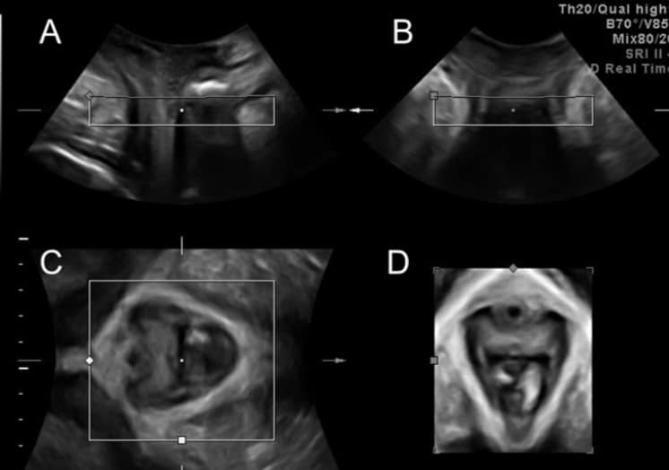 Ecografía Perineal | Sonolife
